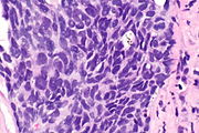 Non-small cell lung carcinoma - Libre Pathology