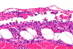 Pericardium - Libre Pathology