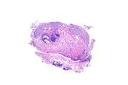 Cystitis glandularis - Libre Pathology