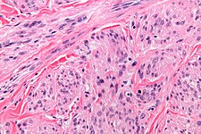 Morphologic patterns - Libre Pathology