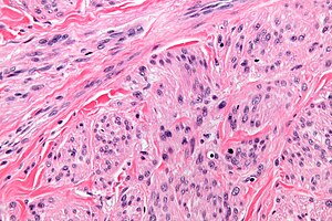 Morphologic patterns - Libre Pathology