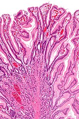 Peutz-Jeghers polyp - Libre Pathology