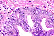 Intraductal carcinoma of the prostate - Libre Pathology
