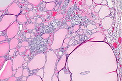 C-cell hyperplasia - Libre Pathology