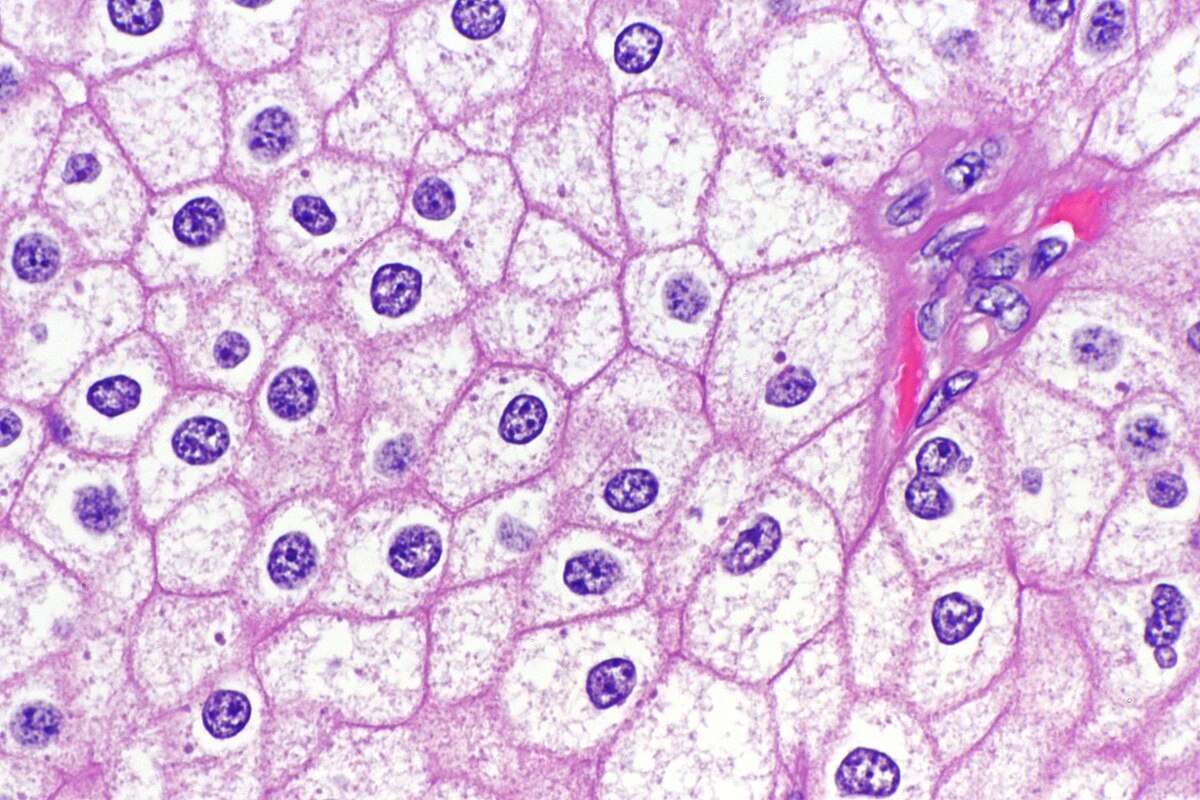 File:Chromophobe renal cell carcinoma -- very high mag.jpg - Libre ...