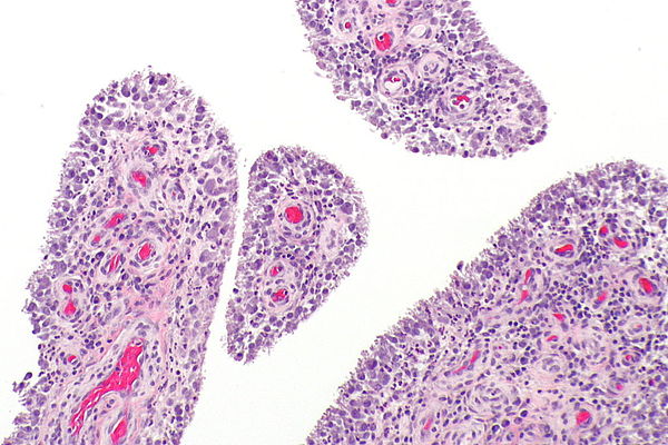 Acute synovitis - Libre Pathology