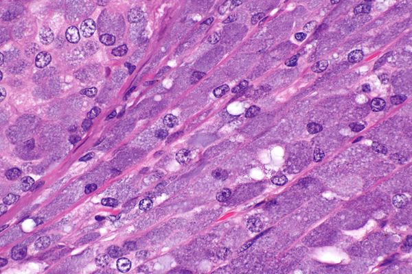 Acinic cell carcinoma - Libre Pathology