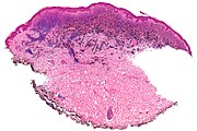 Melanocytic lesions - Libre Pathology