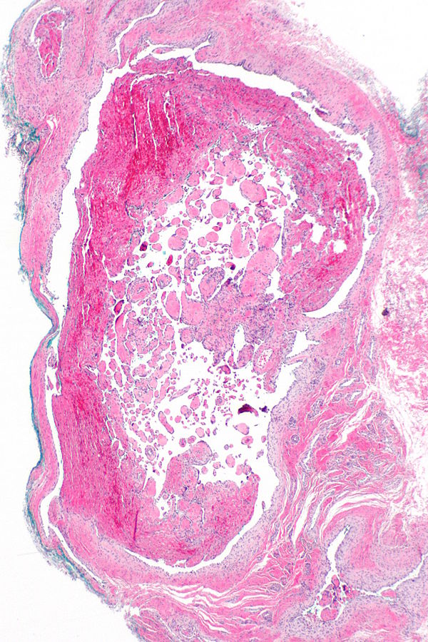 Intravascular papillary endothelial hyperplasia - Libre Pathology
