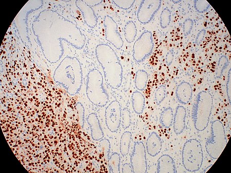 Estrogen receptor - Libre Pathology