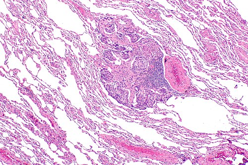 lung cancer histology quiz