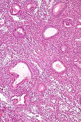 Simple endometrial hyperplasia - Libre Pathology