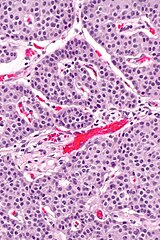 Neuroendocrine tumour of the pancreas - Libre Pathology
