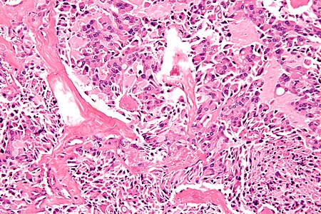 Medullary thyroid carcinoma - Libre Pathology