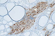 C-cell hyperplasia - Libre Pathology