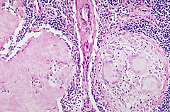 Sarcoidosis - Libre Pathology