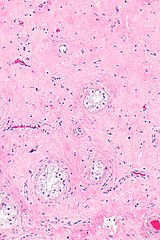 Testicular scar - Libre Pathology