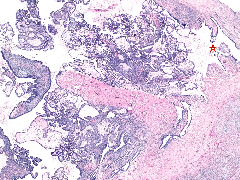 Case 112 - Libre Pathology
