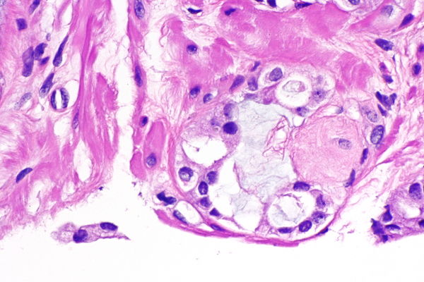 Mucinous fibroplasia - Libre Pathology