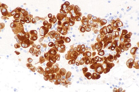 ROS1-rearranged non-small cell lung carcinoma - Libre Pathology