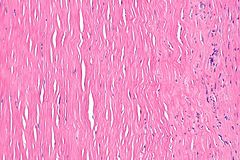 Pleural plaque - Libre Pathology
