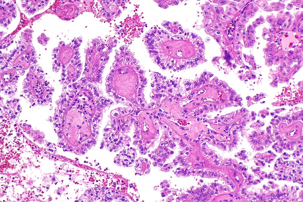 Case 96 - Libre Pathology