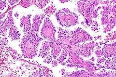Fumarate hydratase-deficient renal cell carcinoma - Libre Pathology