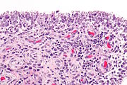 Acute synovitis - Libre Pathology