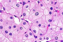 Chromophobe renal cell carcinoma - Libre Pathology