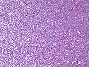 Pheochromocytoma - Libre Pathology