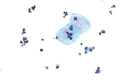 Sarcina - Libre Pathology