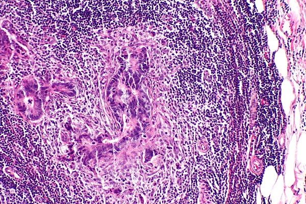Lymph node metastasis - Libre Pathology
