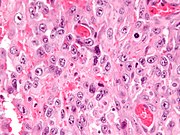 Epithelioid sarcoma - Libre Pathology