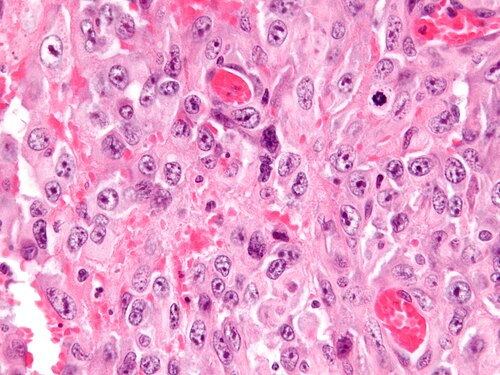 Epithelioid cell lesions - Libre Pathology
