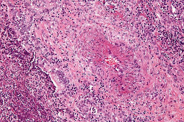 Granulomatosis with polyangiitis - Libre Pathology