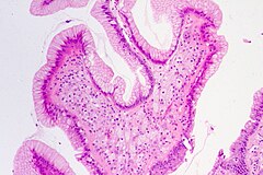 Gastric xanthoma - Libre Pathology