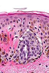 Compound nevus - Libre Pathology