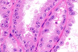 Fumarate hydratase-deficient renal cell carcinoma - Libre Pathology