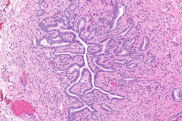 Mesonephric duct remnant - Libre Pathology
