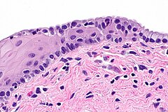 Müllerian cyst of the vagina - Libre Pathology