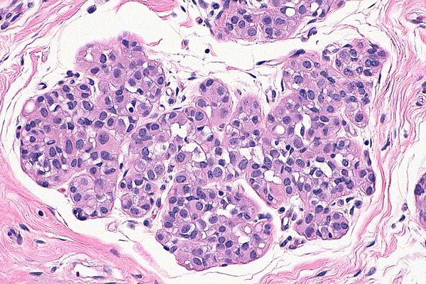 Atypical lobular hyperplasia - Libre Pathology
