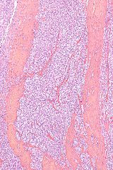 Clear cell sarcoma - Libre Pathology