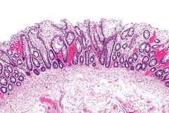 Colorectal xanthomatous polyp - Libre Pathology