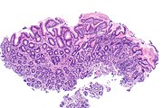 Autoimmune metaplastic atrophic gastritis - Libre Pathology