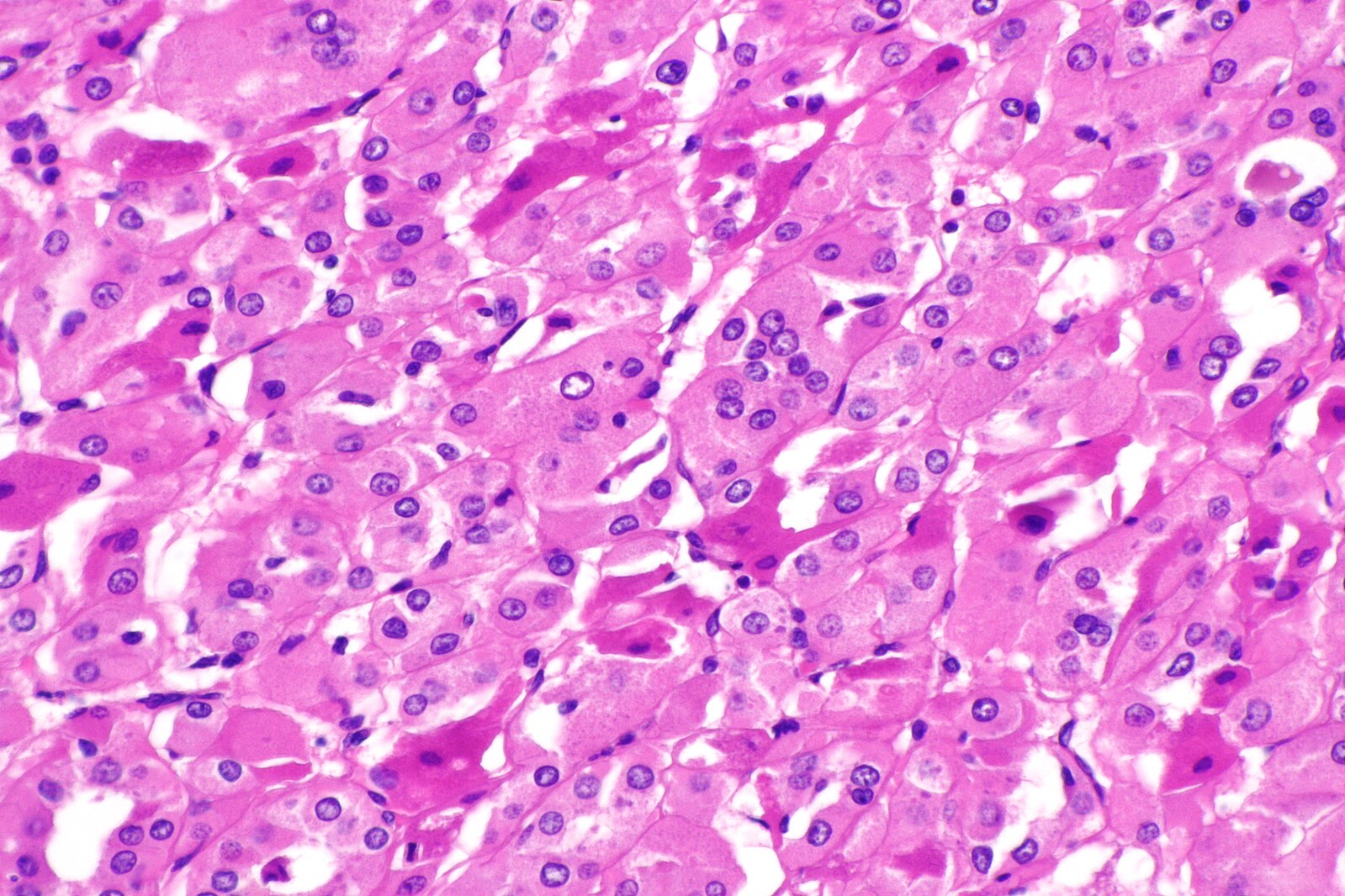 File:Eosinophilic, solid and cystic renal cell carcinoma - 4 ~ high mag ...