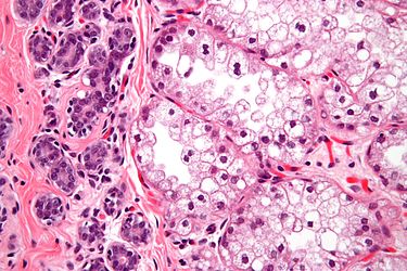 Hobnail pattern - Libre Pathology