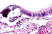 Mucinous tumours of the appendix - Libre Pathology