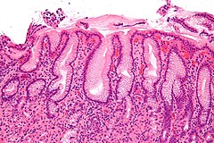 Helicobacter gastritis - Libre Pathology