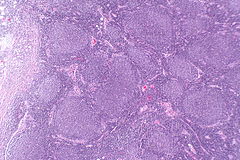 Follicular lymphoma - Libre Pathology