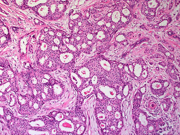 Invasive cribriform carcinoma of the breast - Libre Pathology